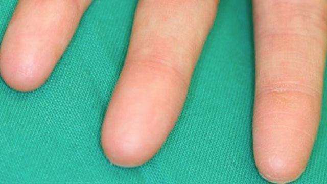 Adermatoglyphia (Adermatoglifiya) nedir? - Sağlık Haberleri