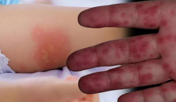 DOMATES GRİBİ NEDİR, KİMLERDE GÖRÜLÜYOR?