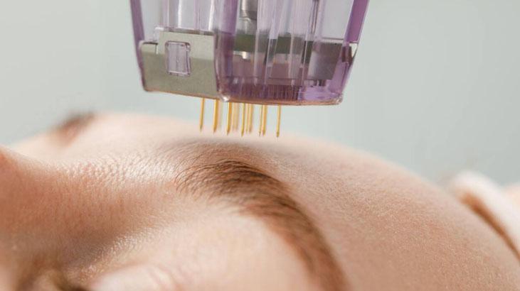 Dermaroller herkese iyi gelmiyor! Deneyenler uyardı, böyle yapılırsa ...