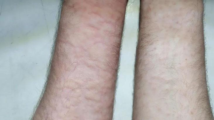 Kendini sivrisineklere yem ediyor! 15 bin ısırığı bile buldu: 'Büyük ...