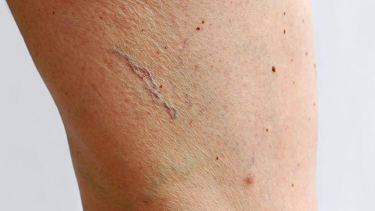 Varis çorabı alıp kullanmadan önce A'dan Z'ye bilinmesi gerekenler ...