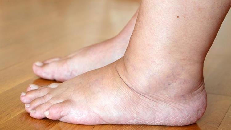 Yürürken bacakta ortaya çıkan ağrı kalpten götürüyor! Aman dikkat, 7 ...