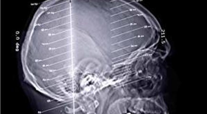 Epilepsi nedir? - Sağlık Haberleri