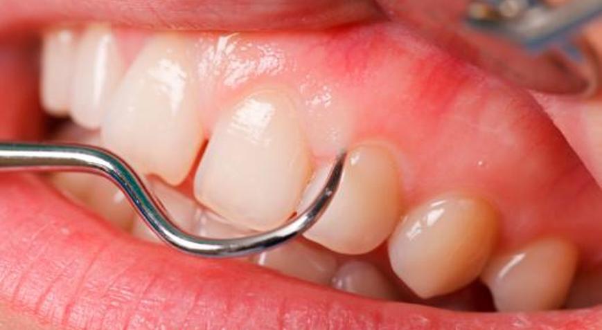 Gingiva Nedir, Neresidir? Gingivanın Görevleri Nelerdir? - En Son ...