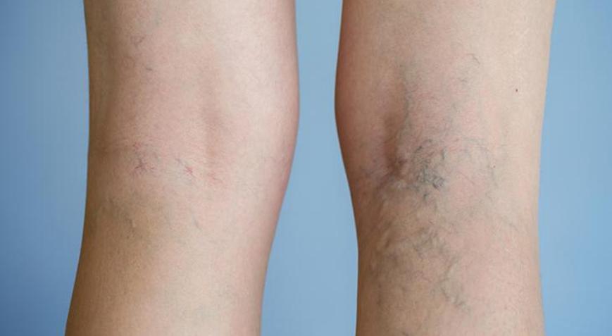 Varis oluşumunu durdurmak için 4 öneri - Varisi engellemek için ne ...